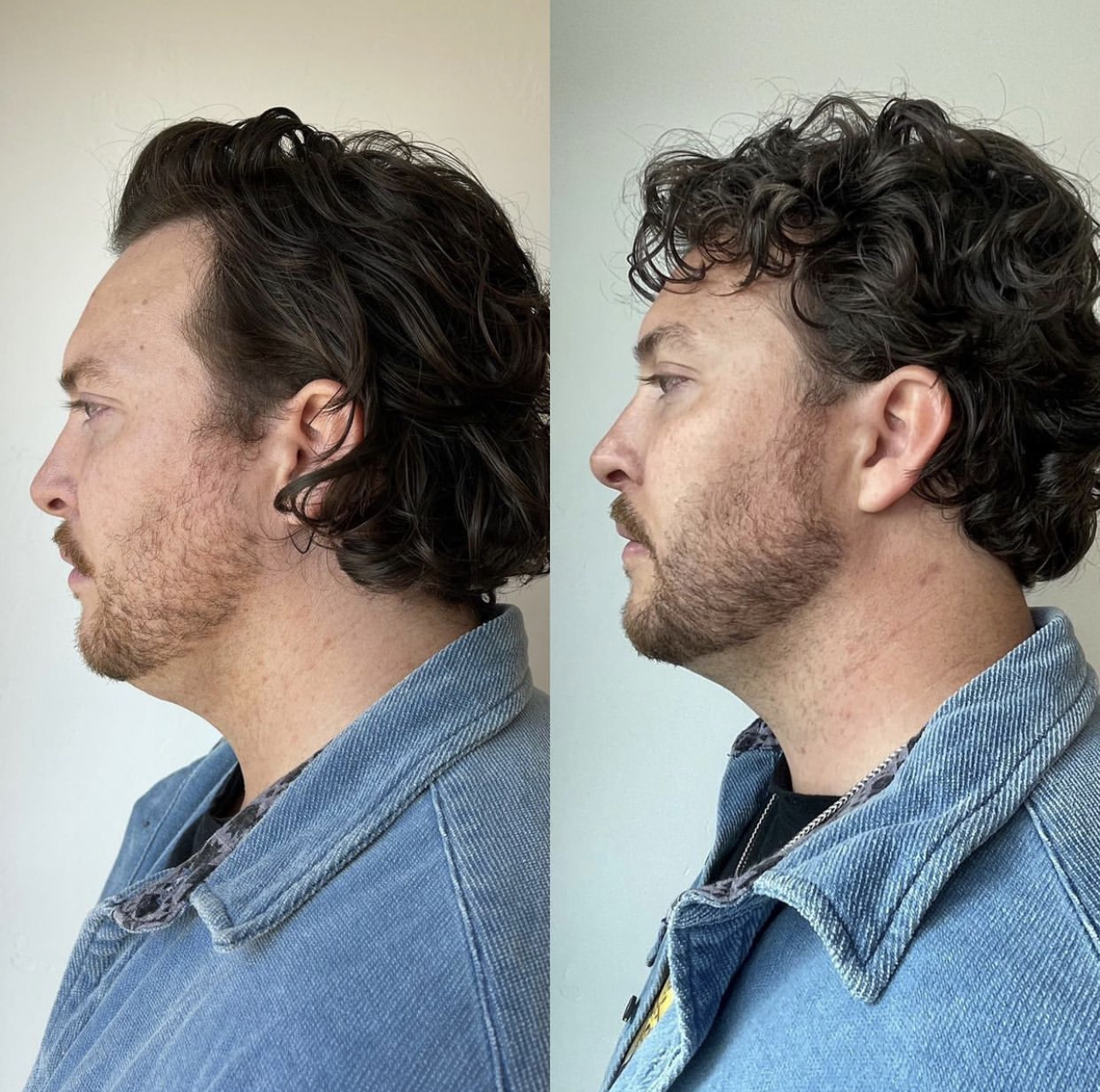 Kybella Injections in Salt Lake City, Utah | The Center